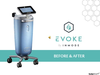 EVOKE by InMode – Before & After | PPT