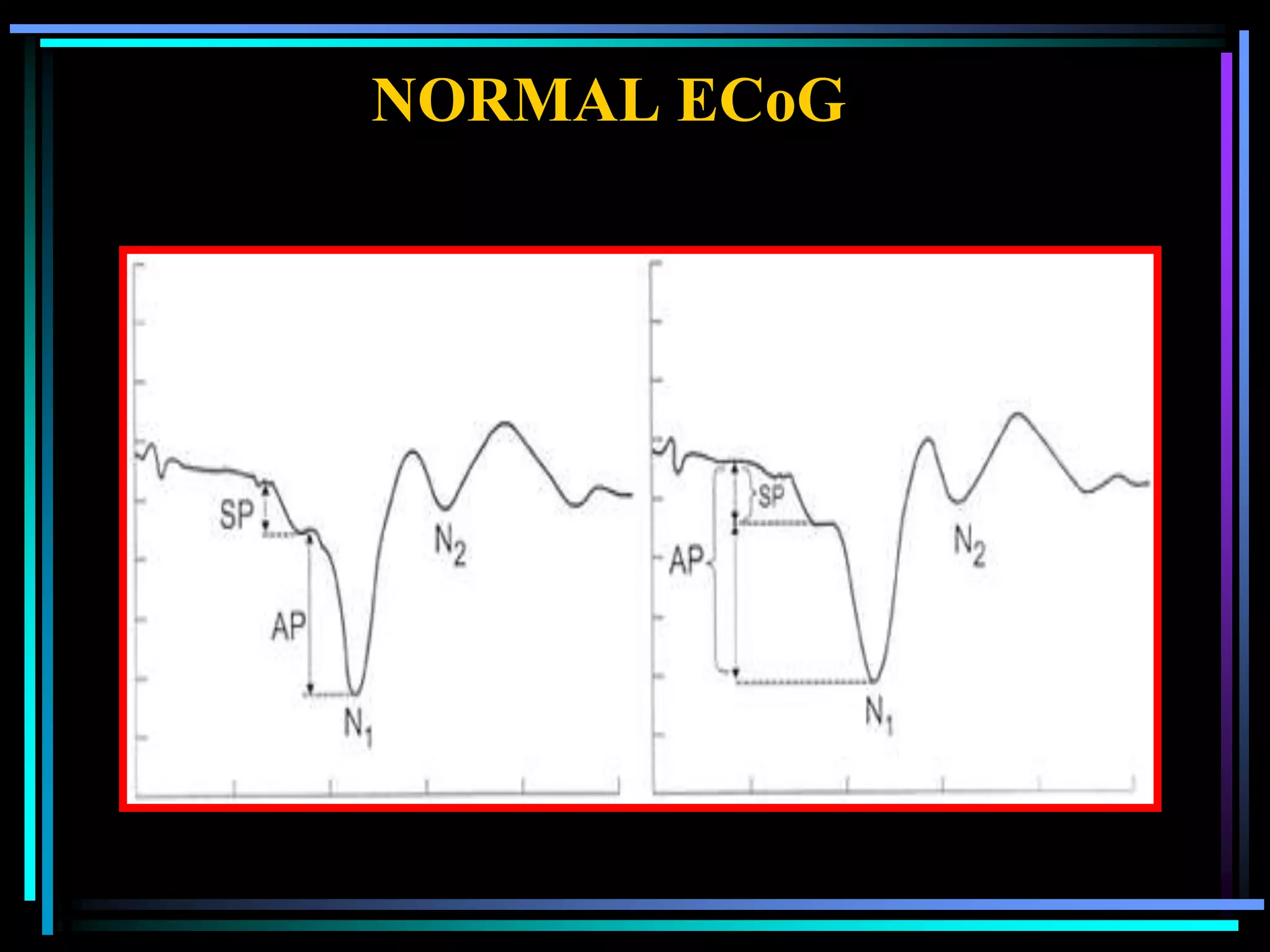 Evoked potential - An overview | PPT