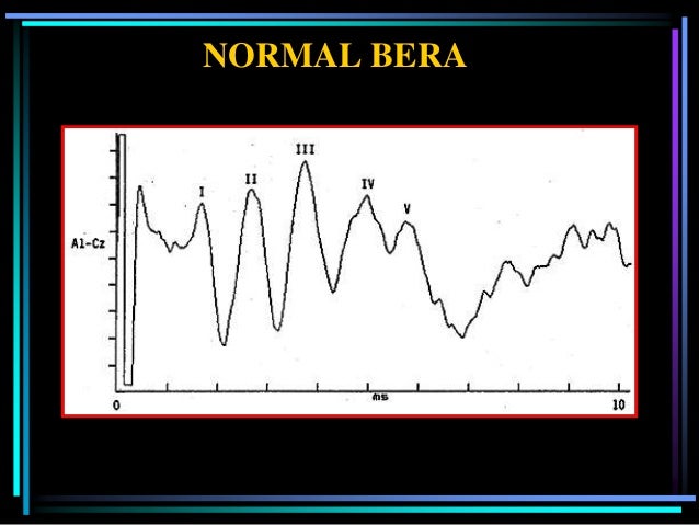 Evoked potential - An overview