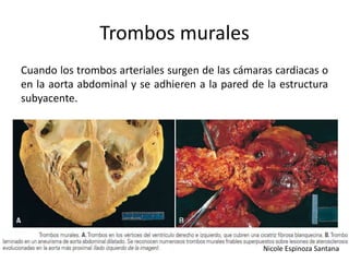 Trombosis | PPTX
