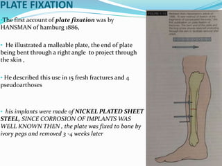 Evolution and generation of orthopaedic implants | PPTX