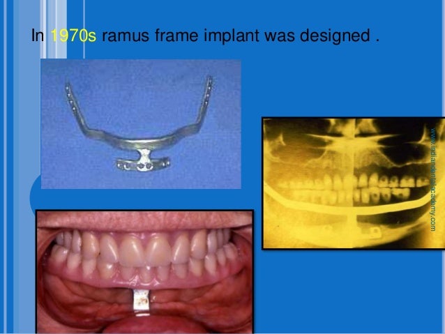 Evolution ,components and classification of implants/ orthodontic pra…