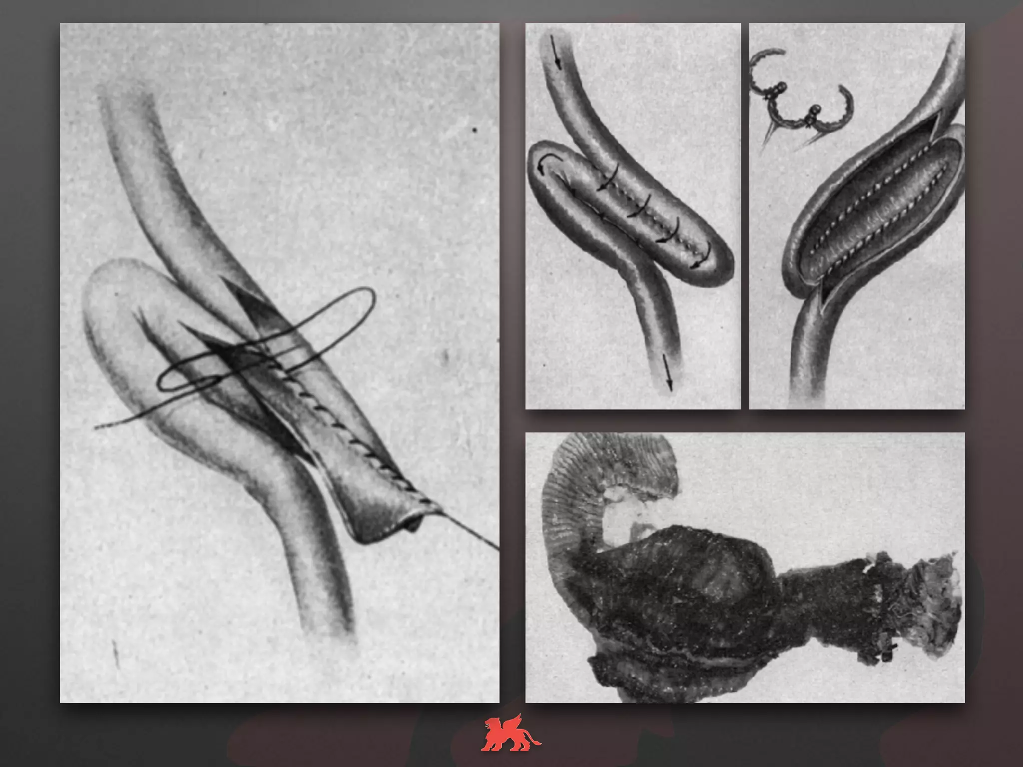 Evolution and new trends of restoration following proctocolectomy | PDF