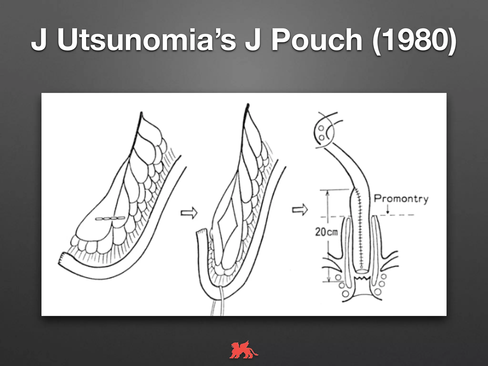 Evolution and new trends of restoration following proctocolectomy | PDF