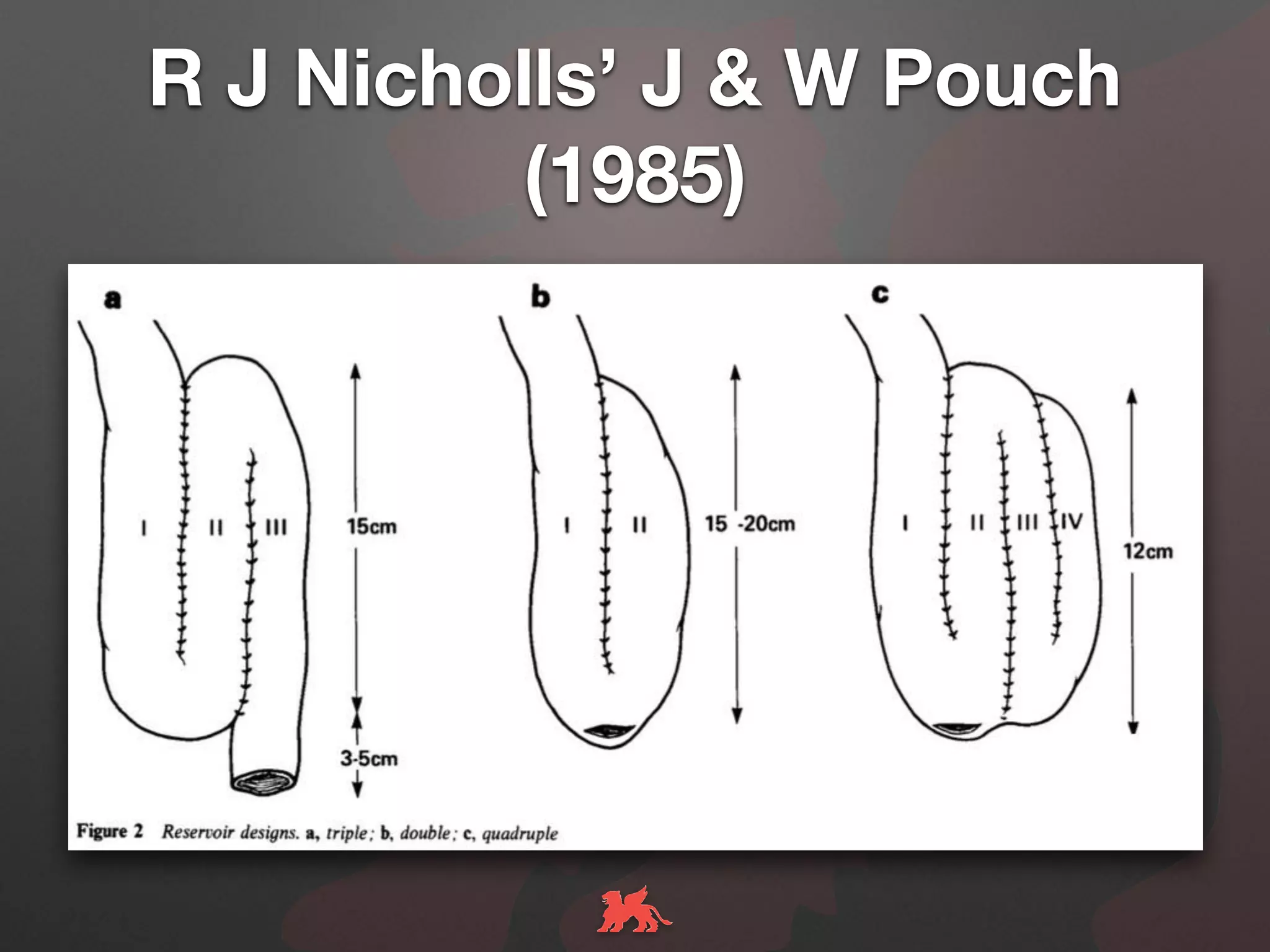 Evolution and new trends of restoration following proctocolectomy | PDF