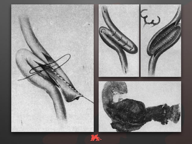 Evolution and new trends of restoration following proctocolectomy | PPT