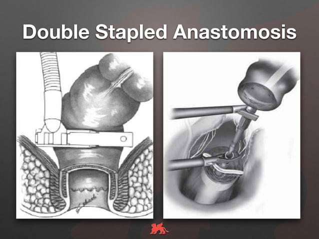 Evolution and new trends of restoration following proctocolectomy | PPT