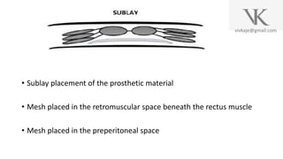 Evolution of Ventral Hernia Repair | PPTX