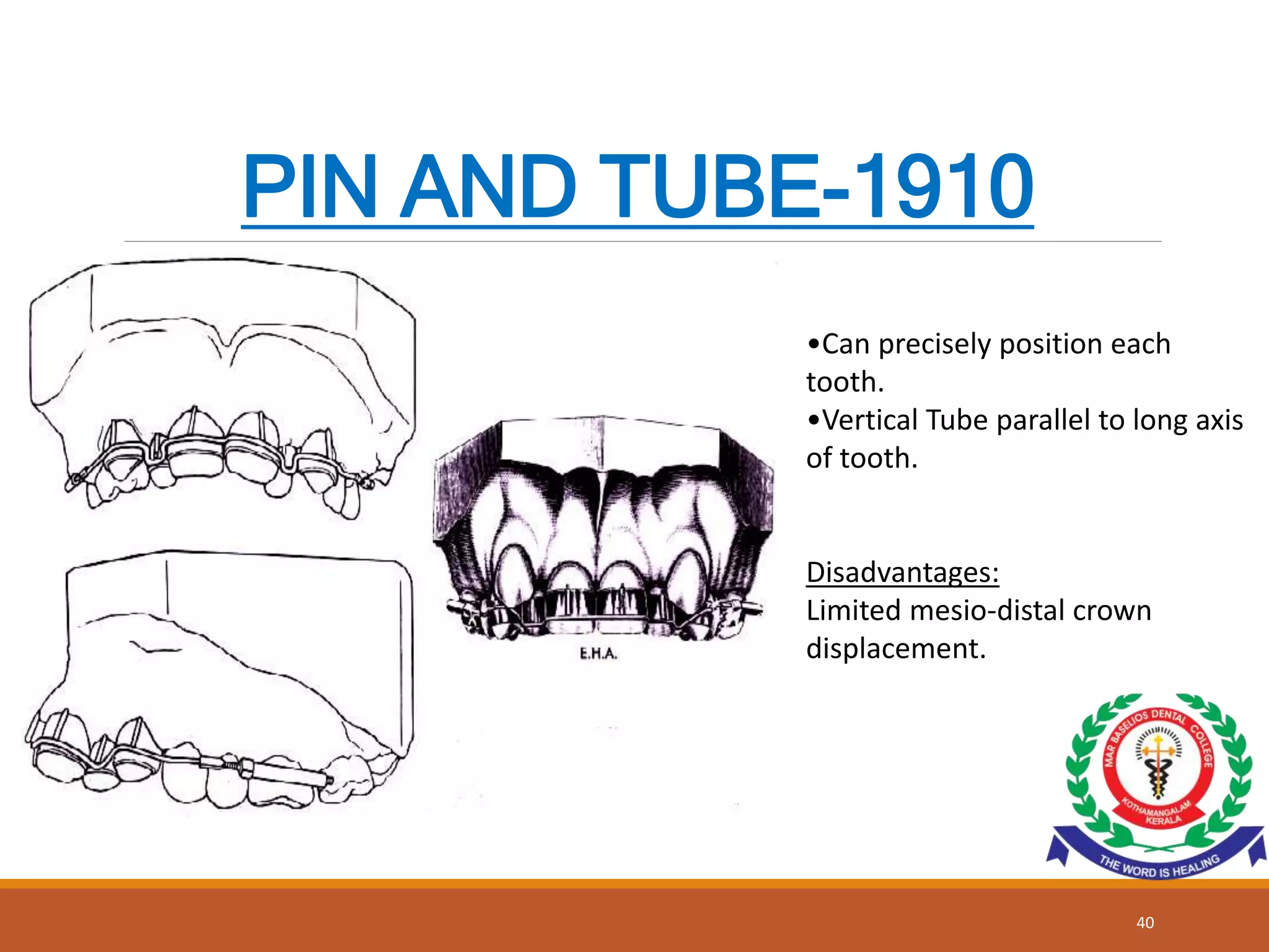 EVOLUTION OF BRACKETS.ppt