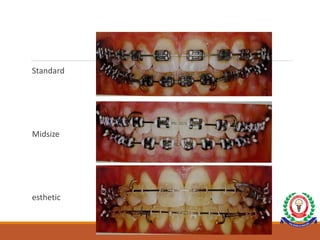 EVOLUTION OF BRACKETS.ppt