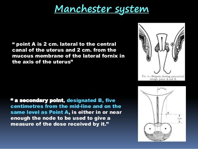 Evolution of gynaecological brachytherapy