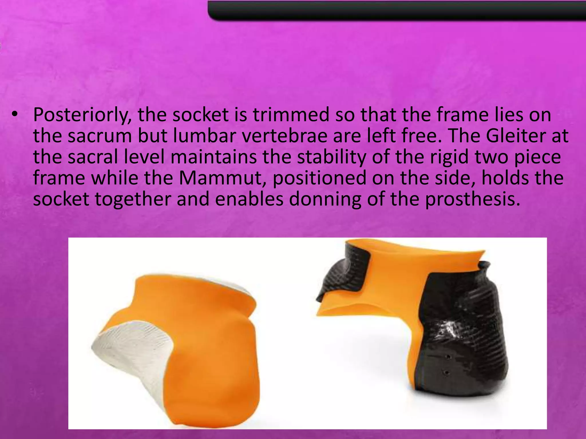 Evolution of hip disarticulation prosthesis | PPTX