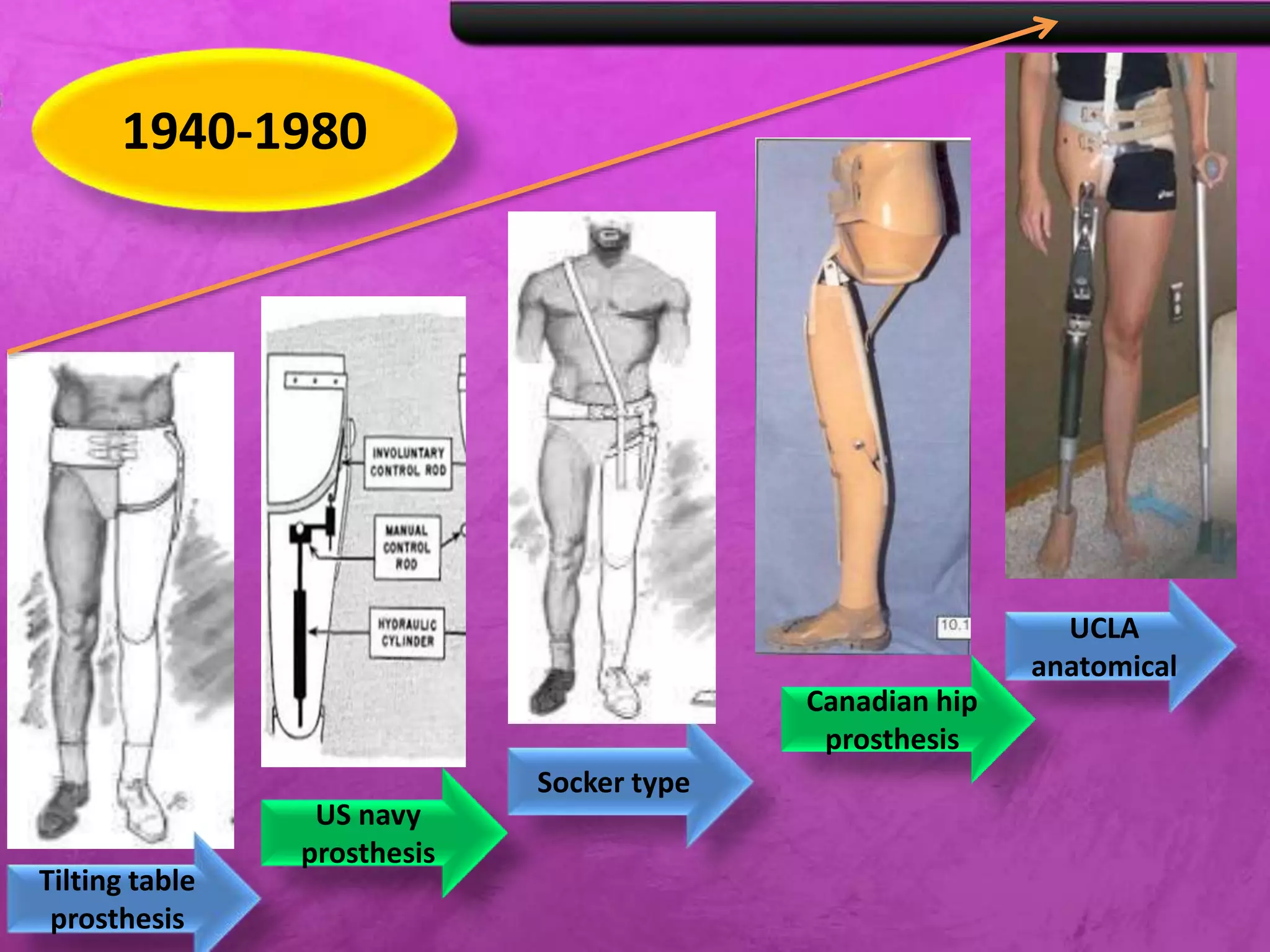 Evolution of hip disarticulation prosthesis | PPTX