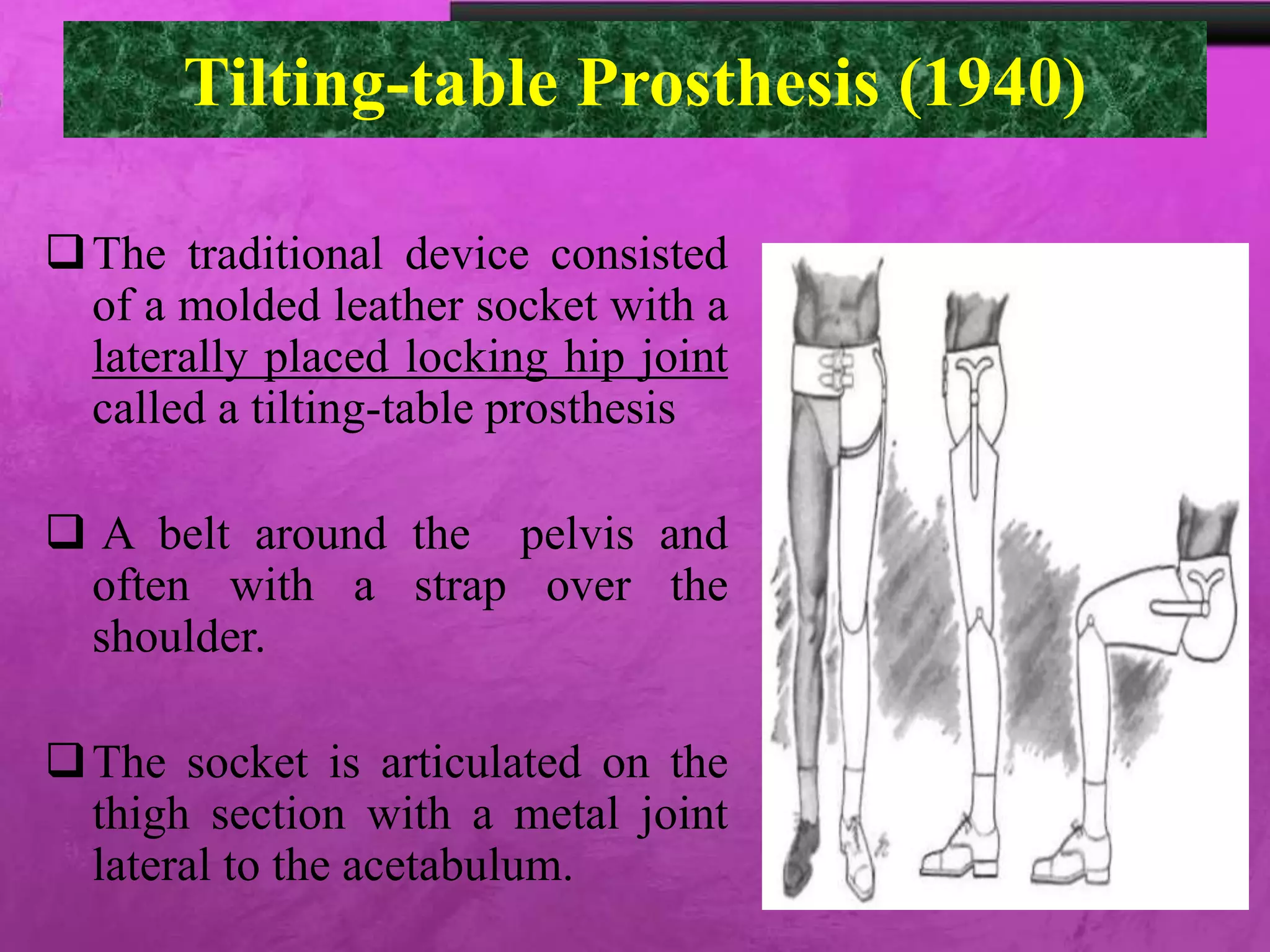 Evolution of hip disarticulation prosthesis | PPTX