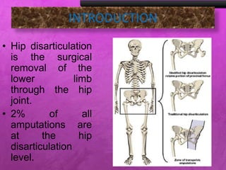 Evolution of hip disarticulation prosthesis | PPTX