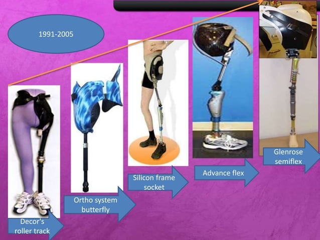 Evolution of hip disarticulation prosthesis | PPTX