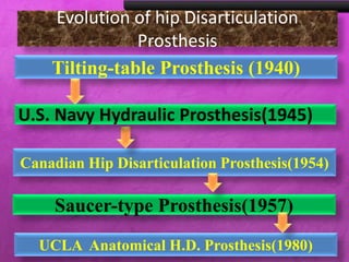 Evolution of hip disarticulation prosthesis | PPTX