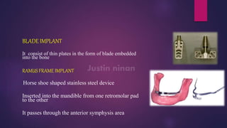 Evolution of implant designs, Dr Justin Ninan | PPTX