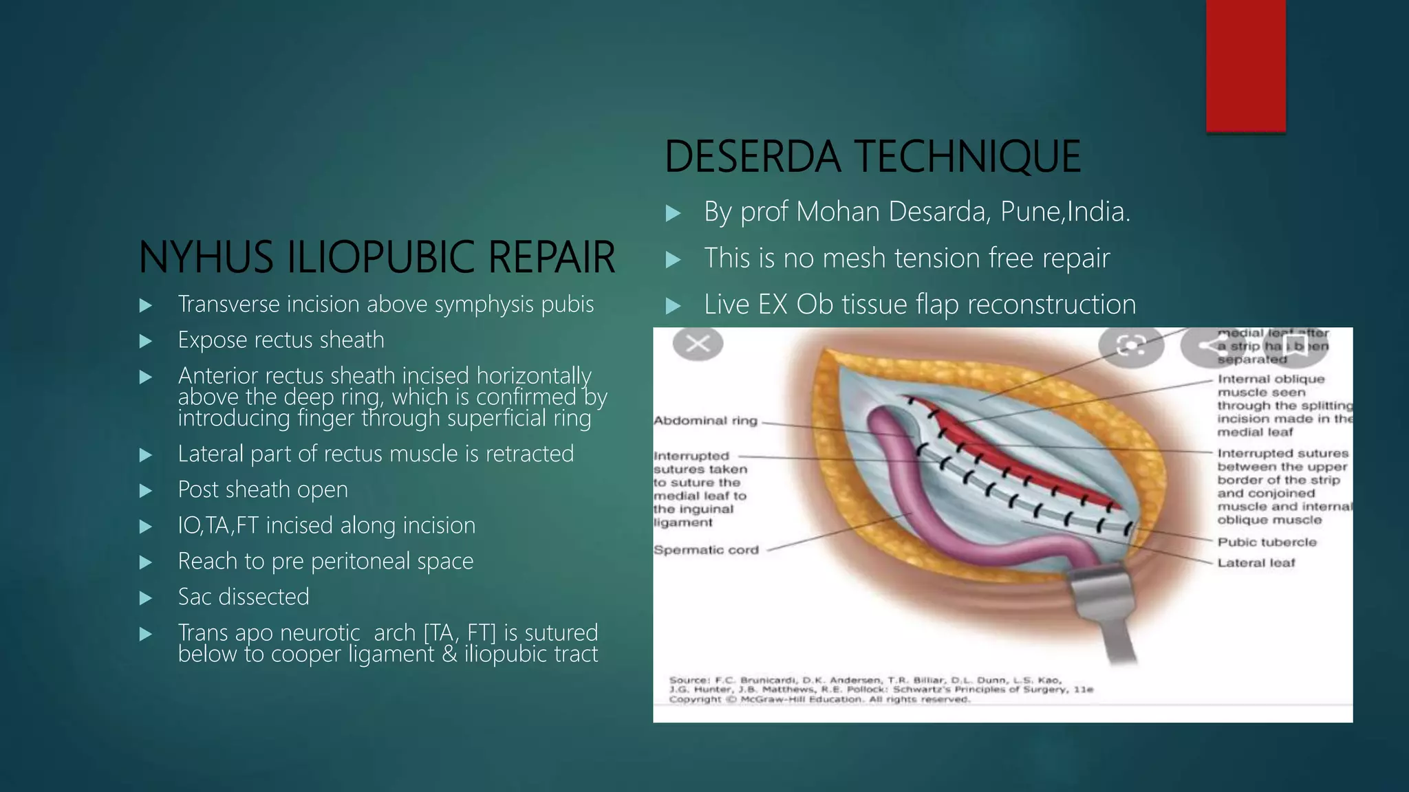 Evolution of inguinal hernia repair | PPTX