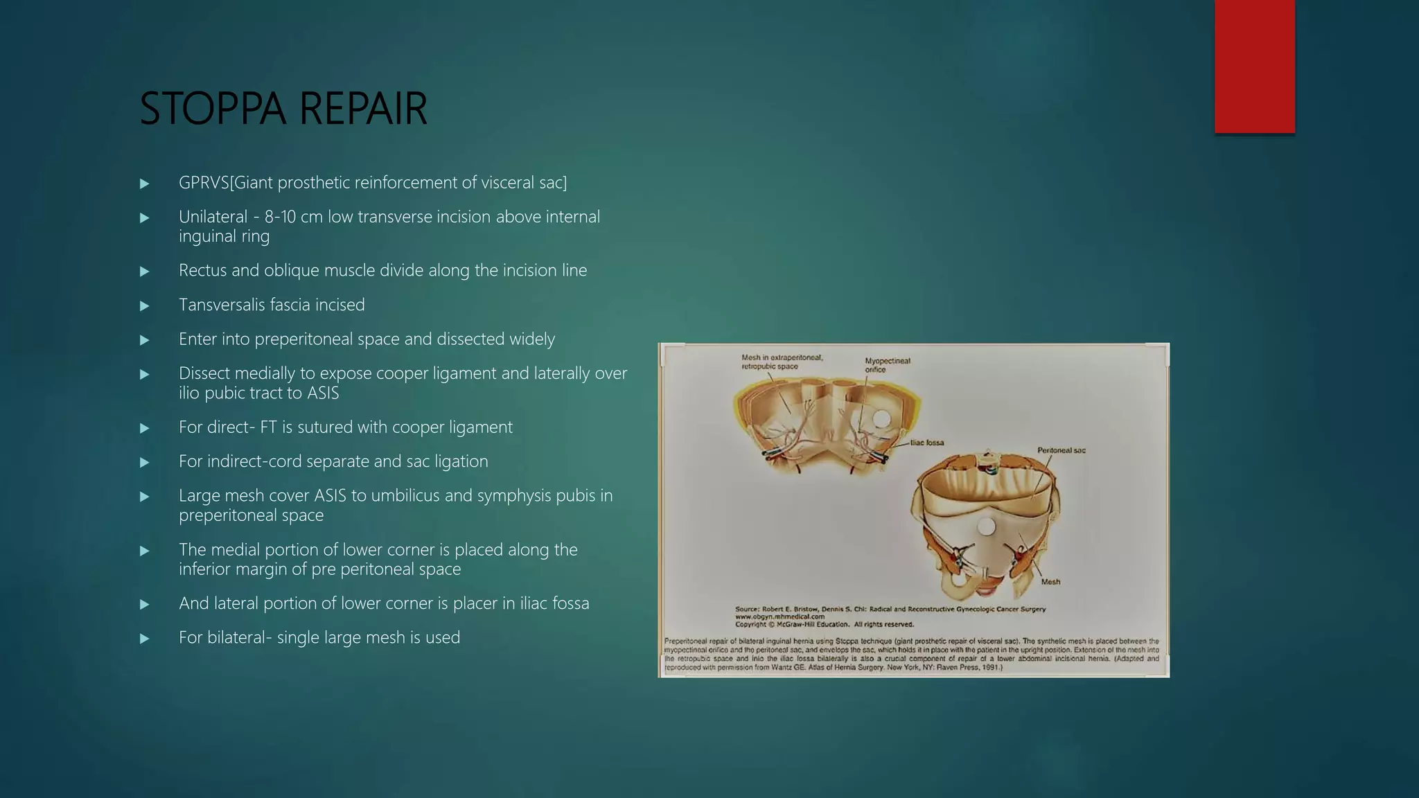 Evolution of inguinal hernia repair | PPTX