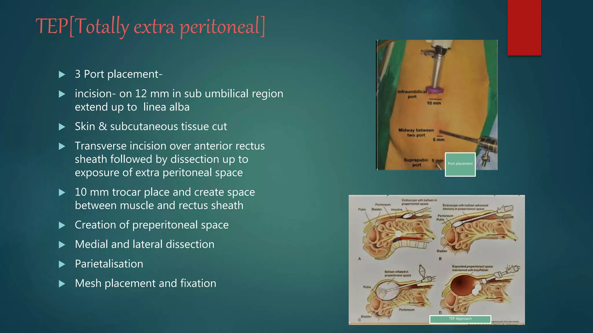 Evolution of inguinal hernia repair | PPTX
