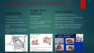 Evolution of inguinal hernia repair | PPTX