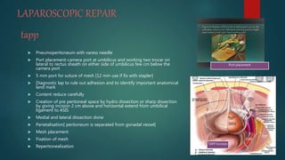 Evolution of inguinal hernia repair | PPTX