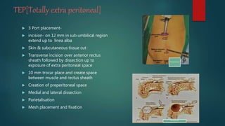 Evolution of inguinal hernia repair | PPTX