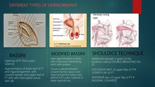 Evolution of inguinal hernia repair | PPTX