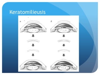 THE EVOLUTION OF LASIK by J. Alberto Martinez MD COPE ID 31538-RS | PPTX