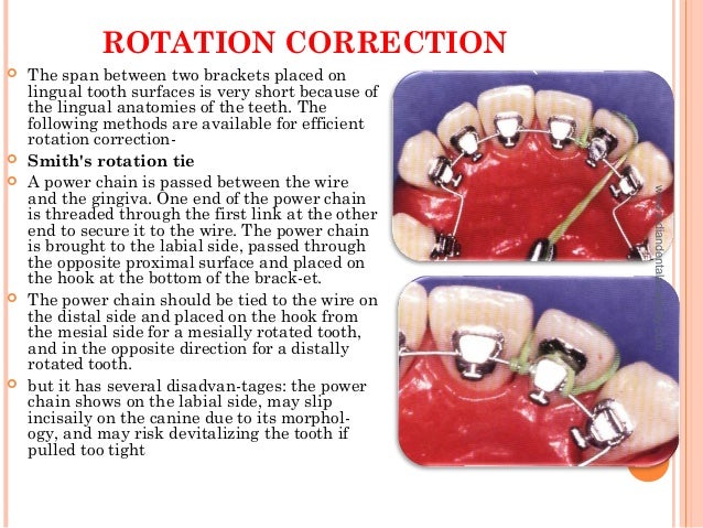 Evolution of lingual orthodontics
