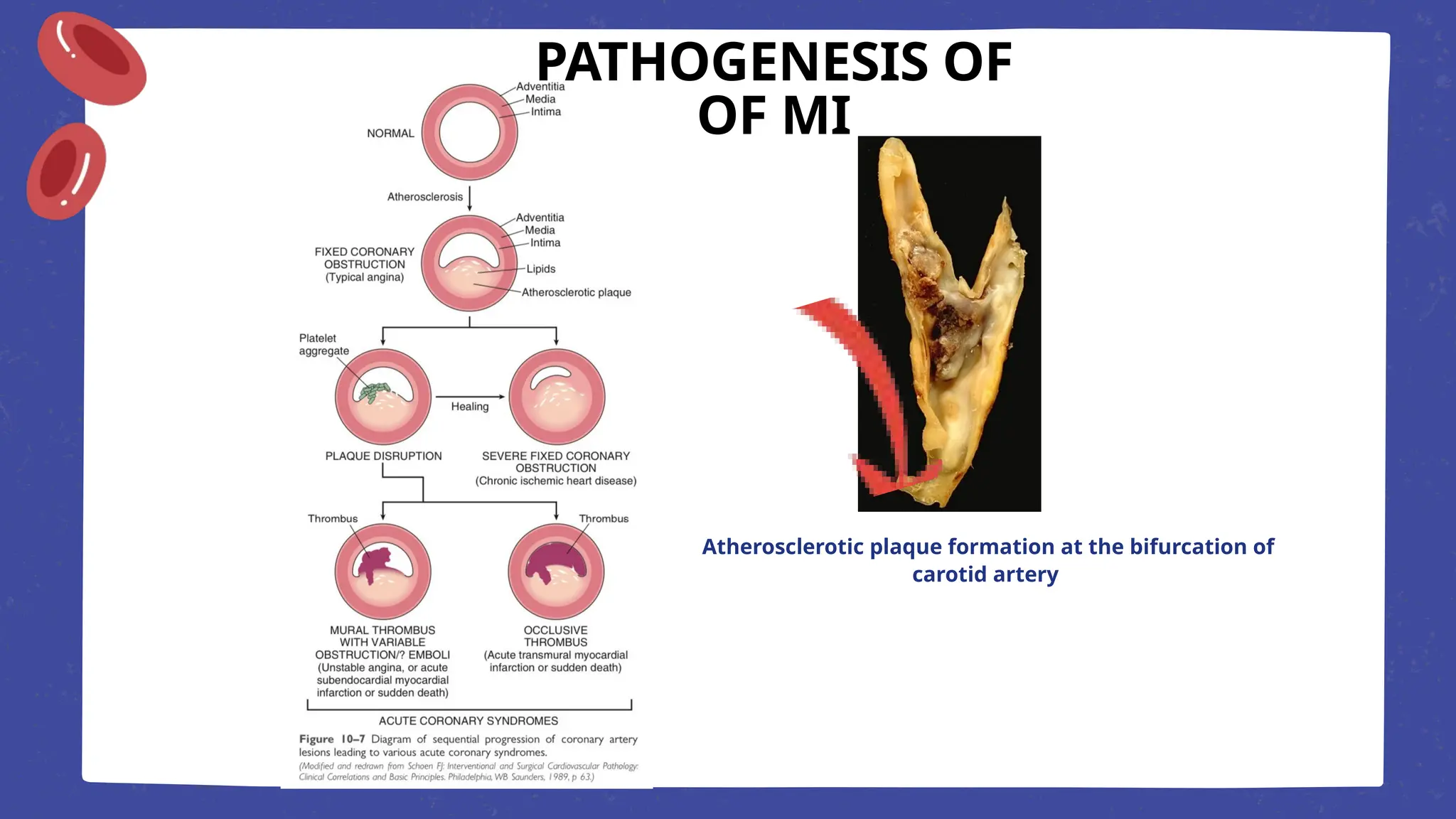 Evolution of morphology of MI cardiac arrest .pptx