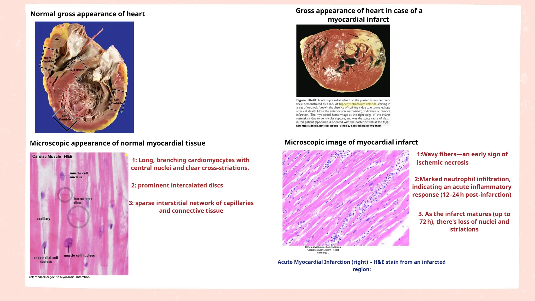 Evolution of morphology of MI cardiac arrest .pptx