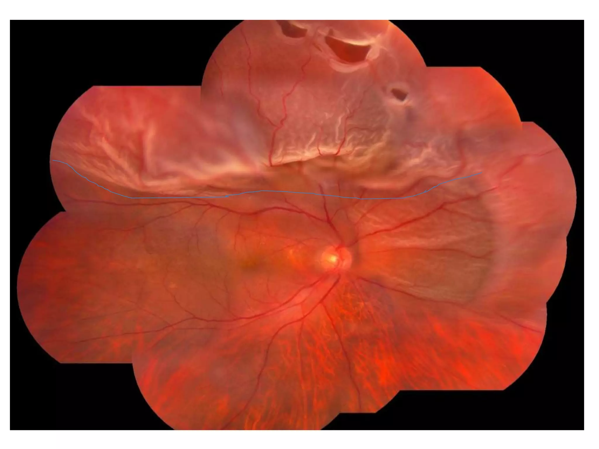 Evolution of retinal detachment surgery | PPT