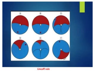 Evolution of retinal detachment surgery | PPT