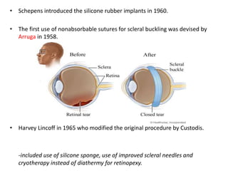Evolution of retinal detachment surgery | PPT