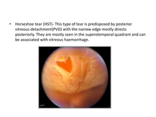 Evolution of retinal detachment surgery | PPT