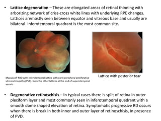 Evolution of retinal detachment surgery | PPT