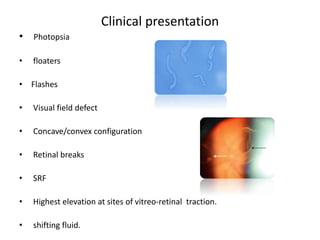 Evolution of retinal detachment surgery | PPT