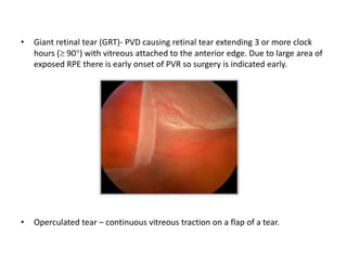 Operculated Tear