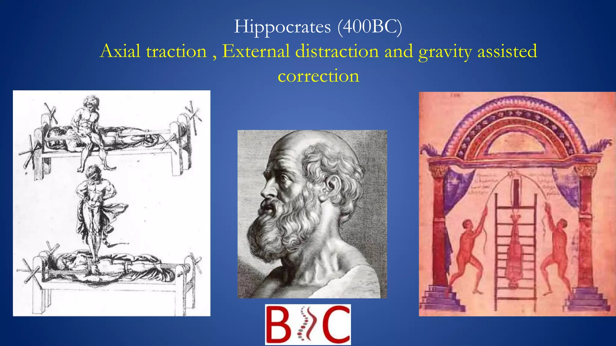 Evolution of surgical strategies instrumentation in scoliosis- dr ...