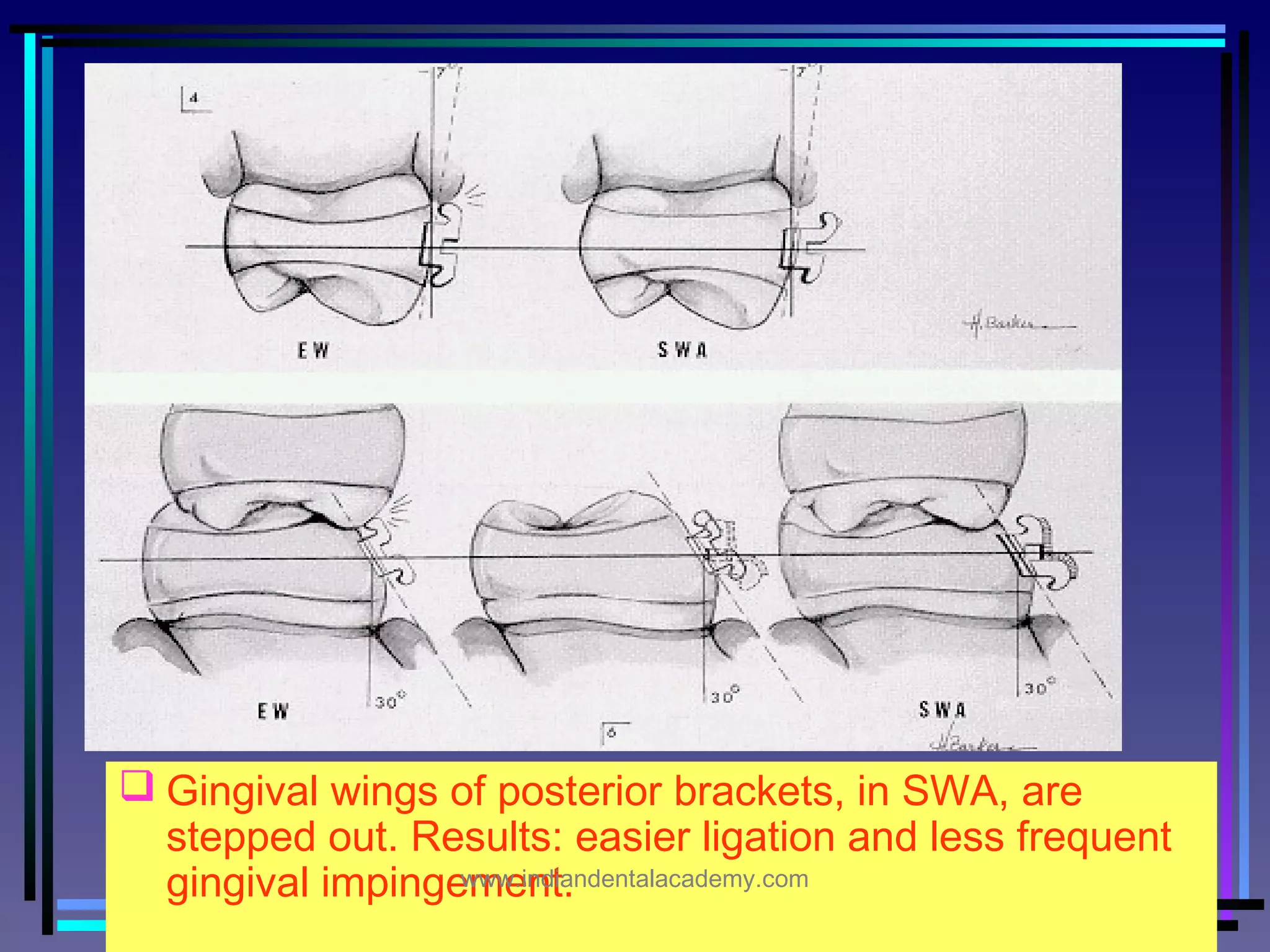 Evolution of straight wire technique /certified fixed orthodontic courses by Indian dental ...