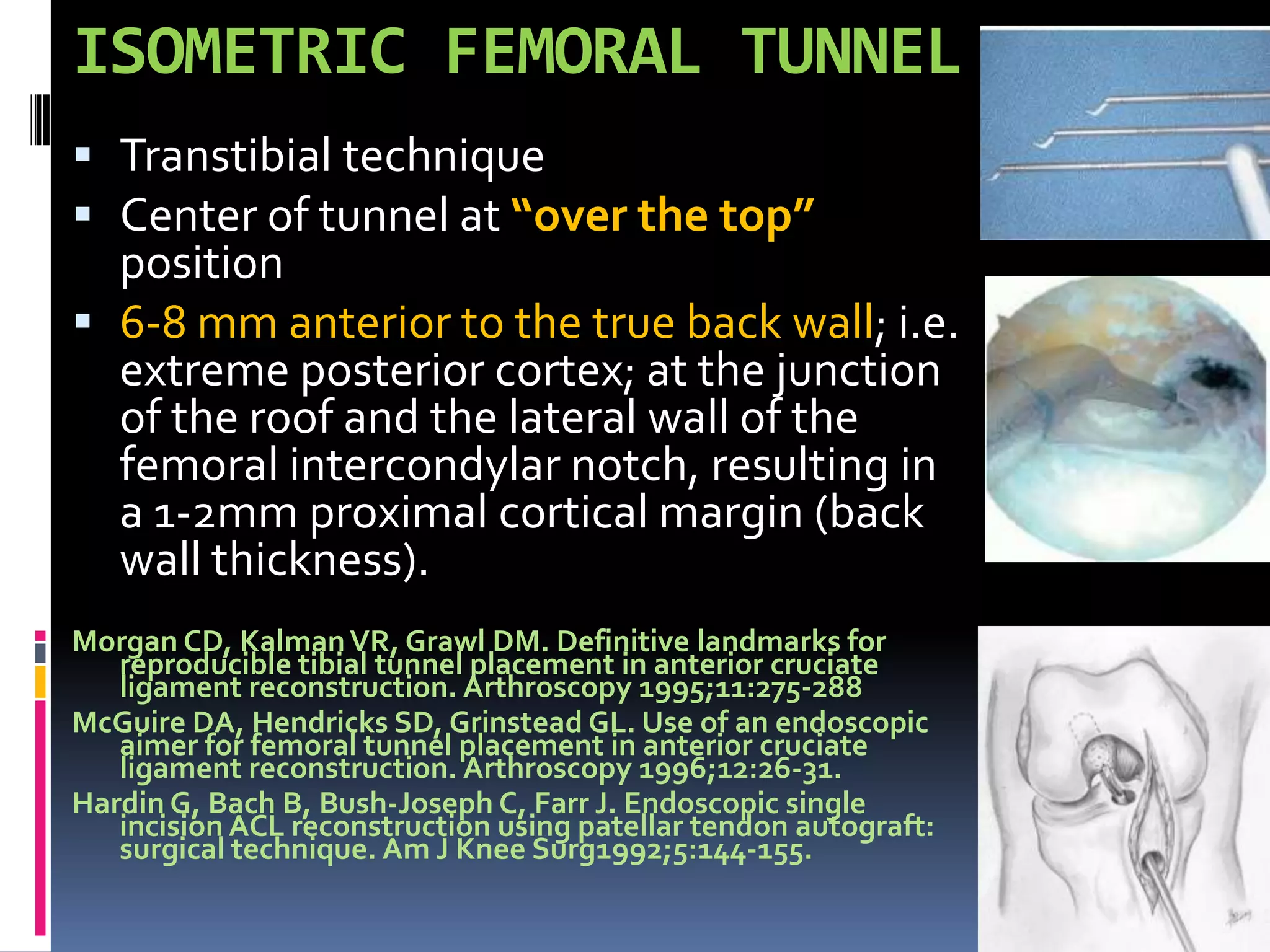 Evolution of tunnel placement in ACL reconstruction | PPTX