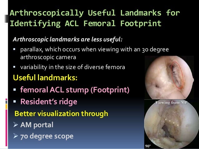 Evolution of tunnel placement in ACL reconstruction