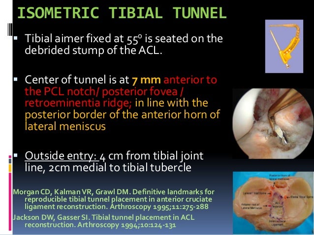 Evolution of tunnel placement in ACL reconstruction