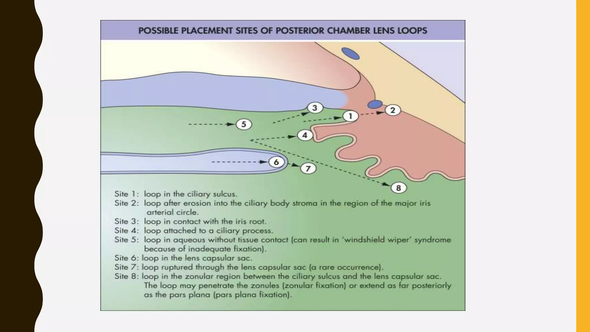 Evolution, types, materials of iol | PPTX