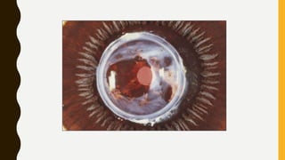 Evolution, types, materials of iol | PPTX