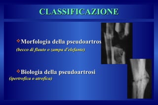 Evoluzione del PRP (Platelet-rich plasma) | PPT