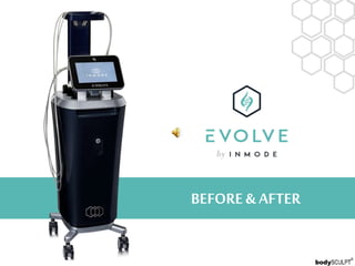 EVOLVE by InMode – Before & After | PPT