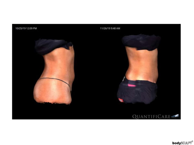 EVOLVE by InMode – Before & After | PPT